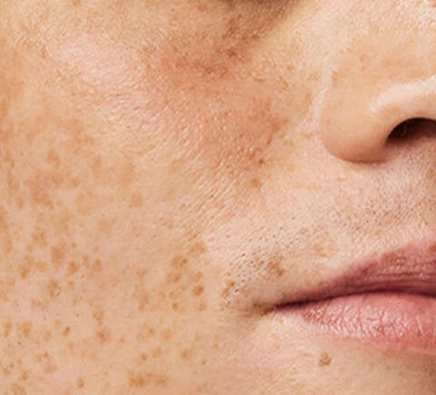 exfoliation for face