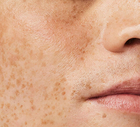 Hyperpigmentation & How to Manage It | SkinCeuticals Australia