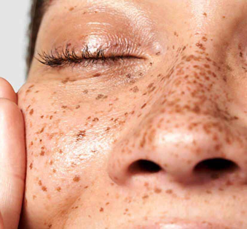 dark spots from spots